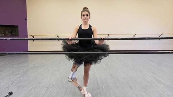 This girl became a ballet dancer despite having had her leg...